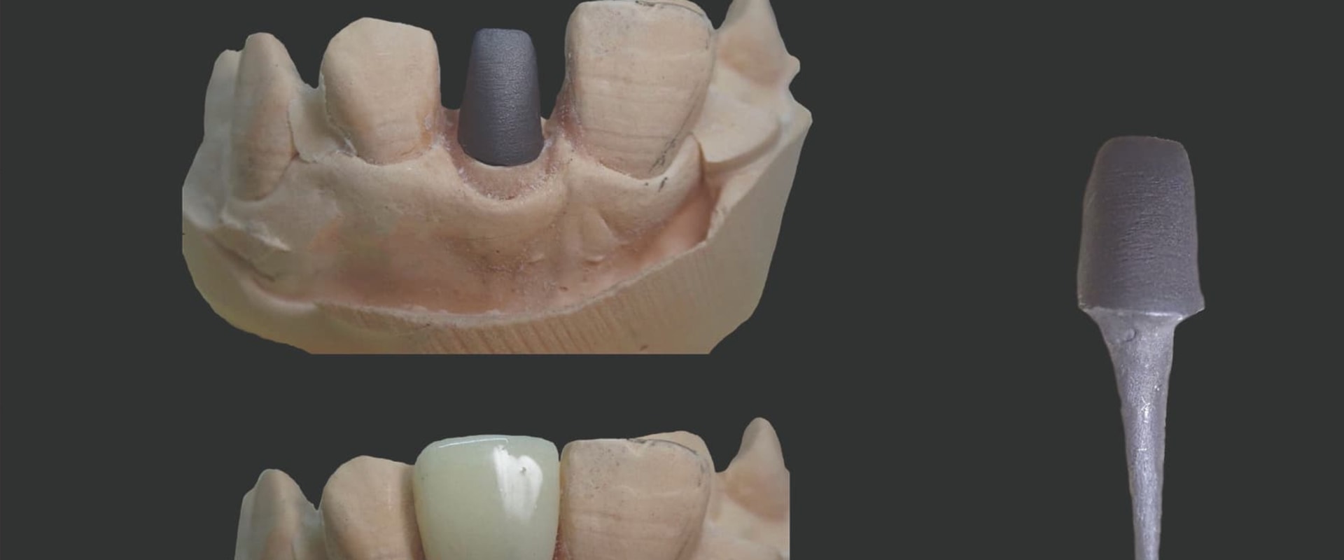 What is a Post and Core Restoration Procedure?