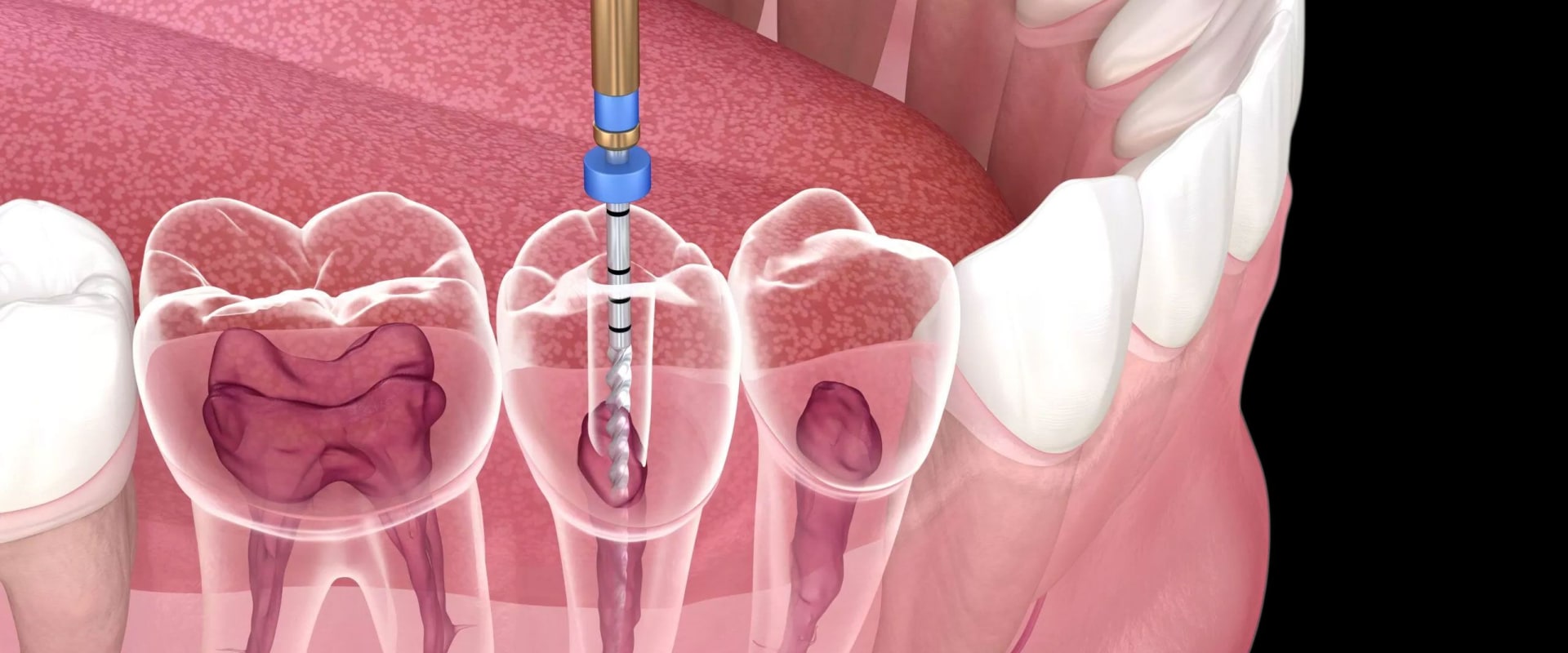 Restoring Your Smile: Root-Supported Overdentures In London As The Next ...
